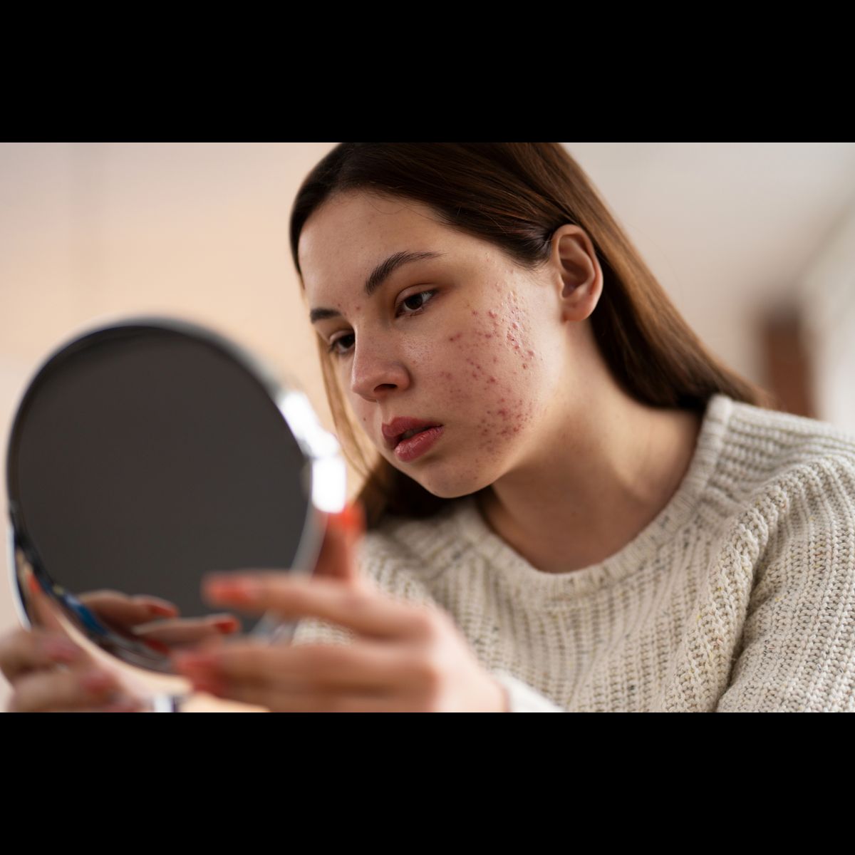 A new twist in the fight against acne