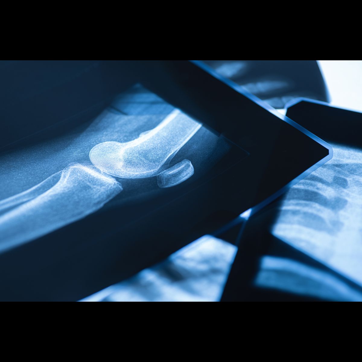 Innovations in Tissue Engineering: Bone regeneration